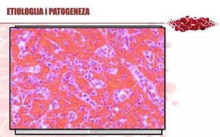 Hereditarna sferocitoza | PPTX