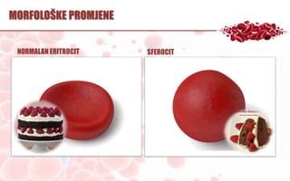 Hereditarna sferocitoza | PPTX