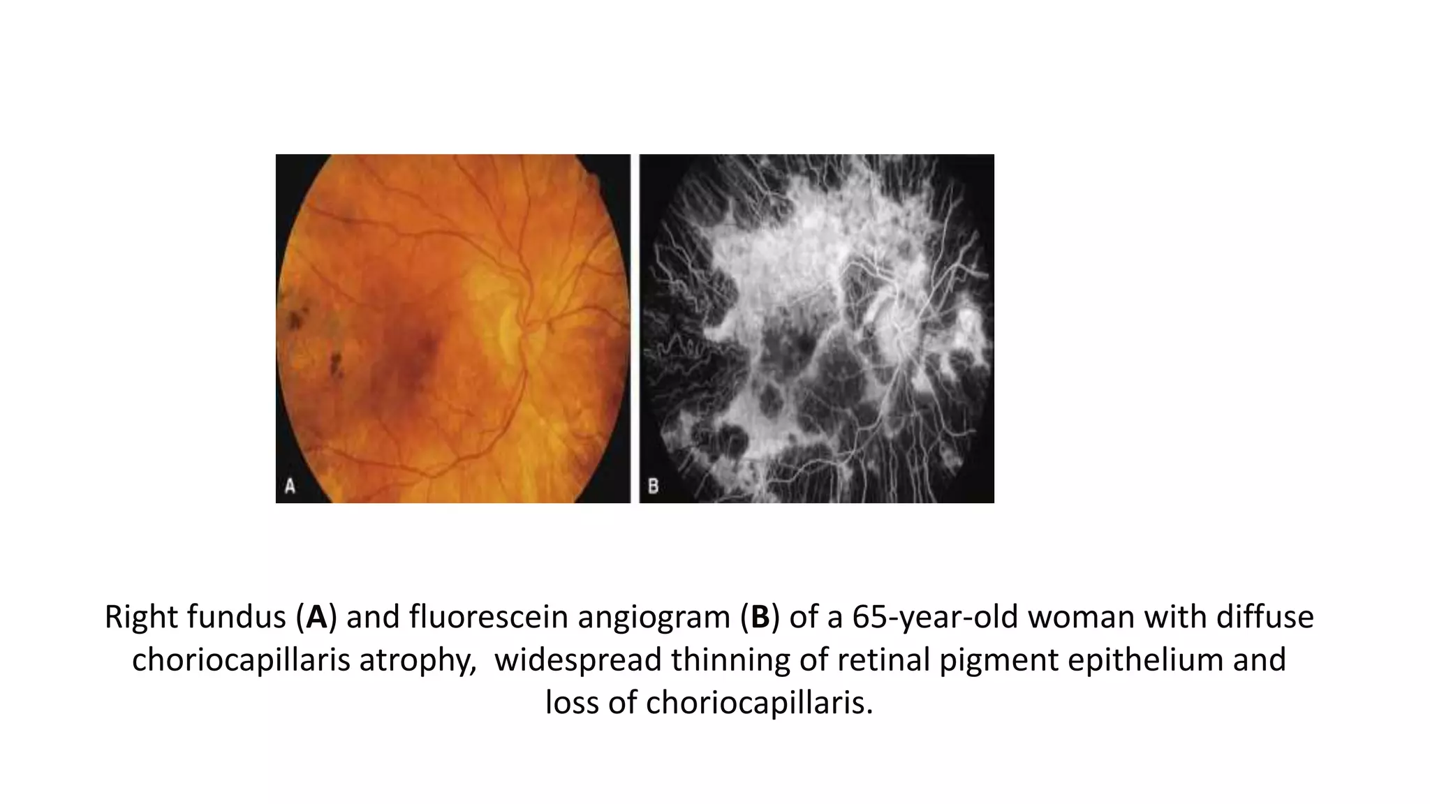 Hereditary choroidal diseases | PPTX