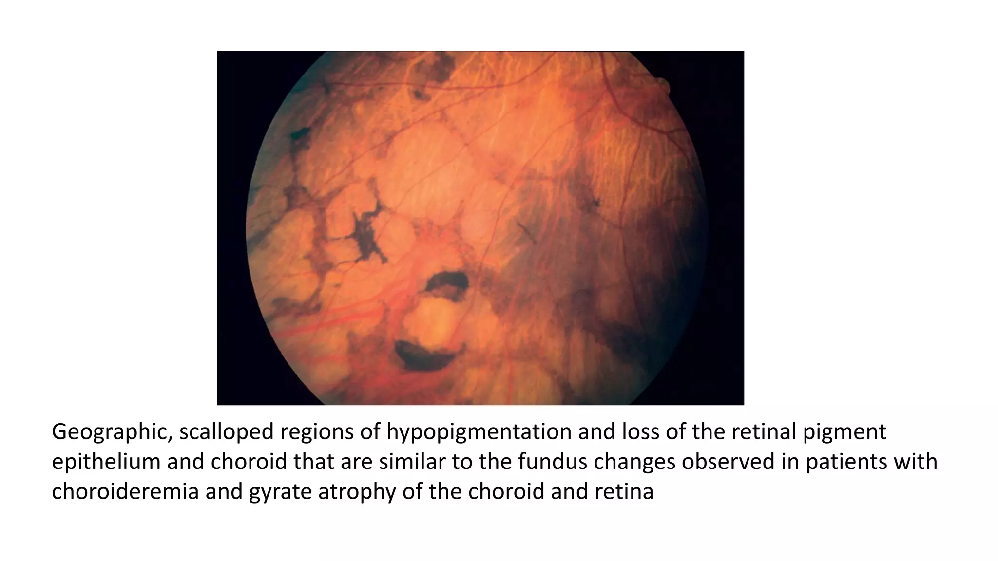 Hereditary choroidal diseases | PPTX