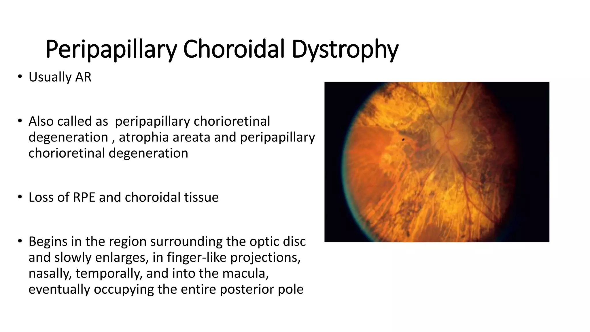 Hereditary choroidal diseases | PPTX