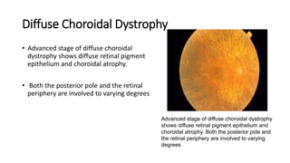 Hereditary choroidal diseases | PPTX