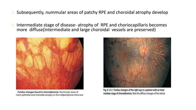 Hereditary choroidal diseases | PPTX | Eye and Vision Conditions ...