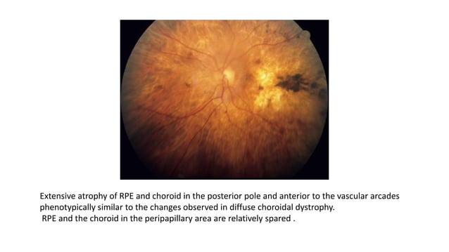 Hereditary choroidal diseases | PPTX | Eye and Vision Conditions ...