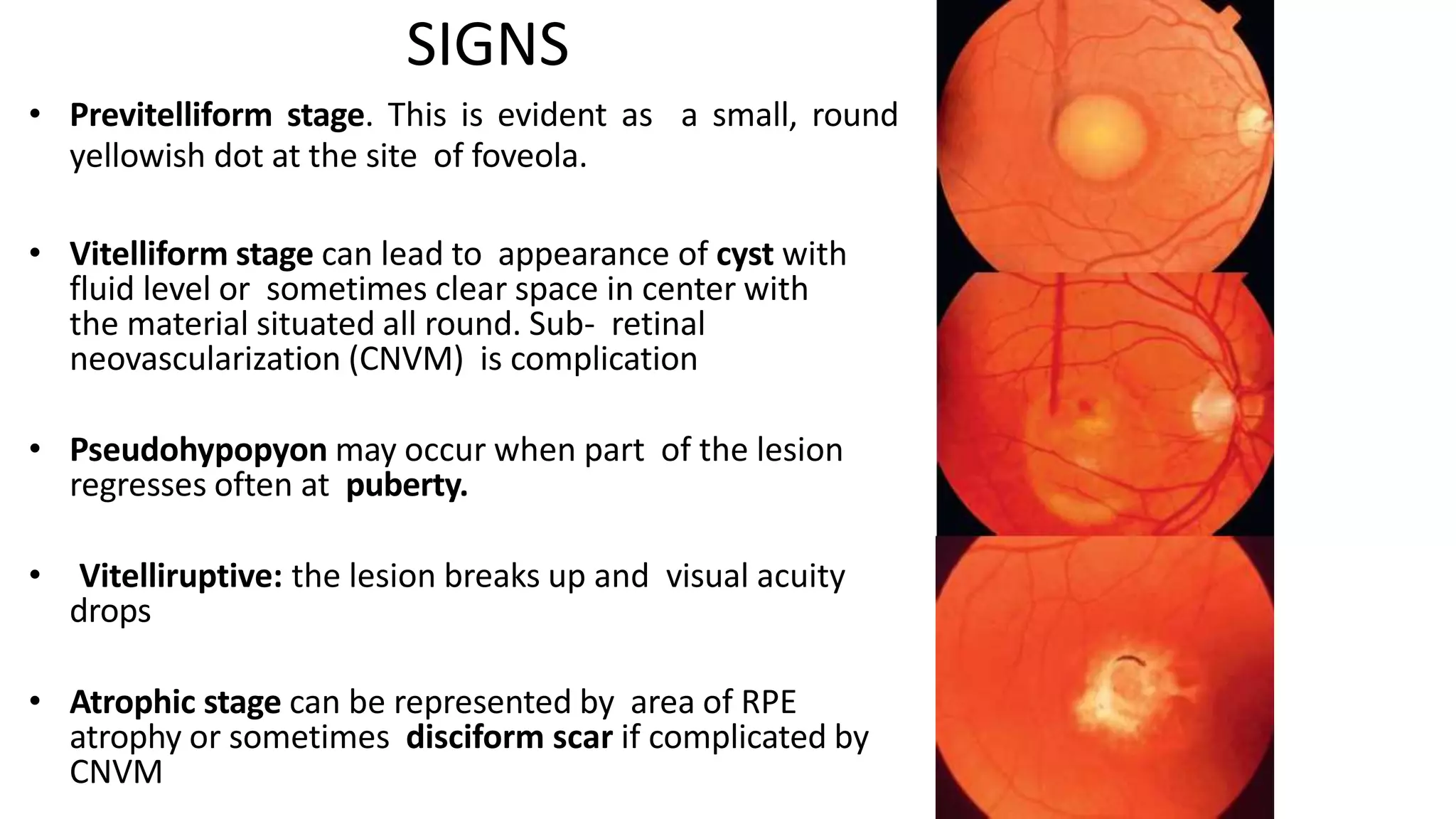 Hereditary macular dystrophies | PPTX | Eye and Vision Conditions ...