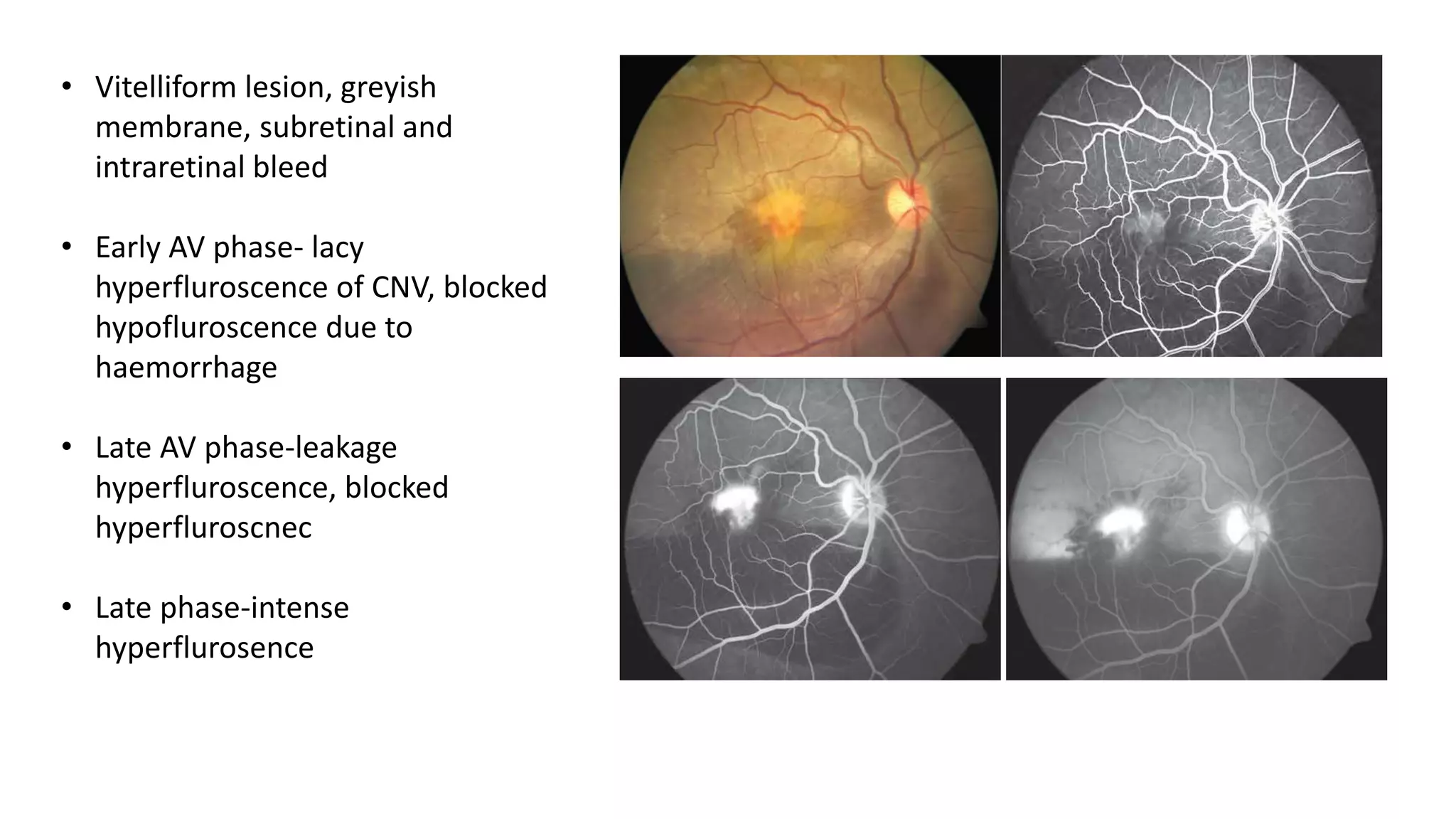 Hereditary macular dystrophies | PPTX