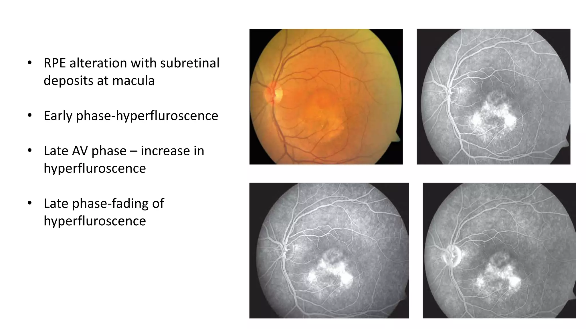 Hereditary macular dystrophies | PPTX | Eye and Vision Conditions ...