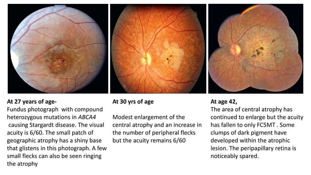Hereditary macular dystrophies | PPTX | Eye and Vision Conditions ...