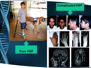 Hereditary spastic paraplegia | PPSX