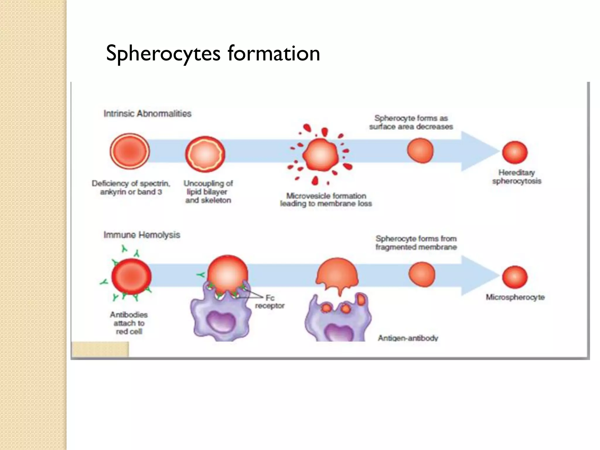 Hereditary spherocytosis | PDF