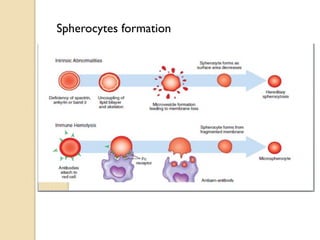 Hereditary spherocytosis | PDF