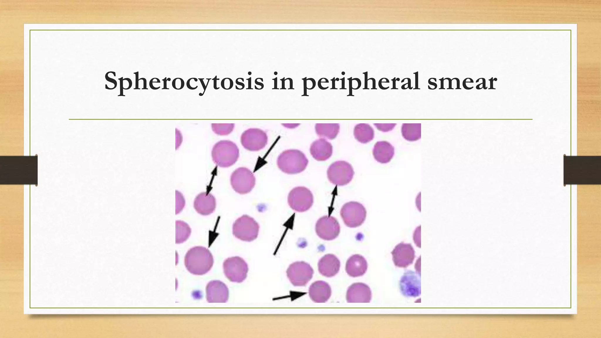Hereditary spherocytosis | PPTX
