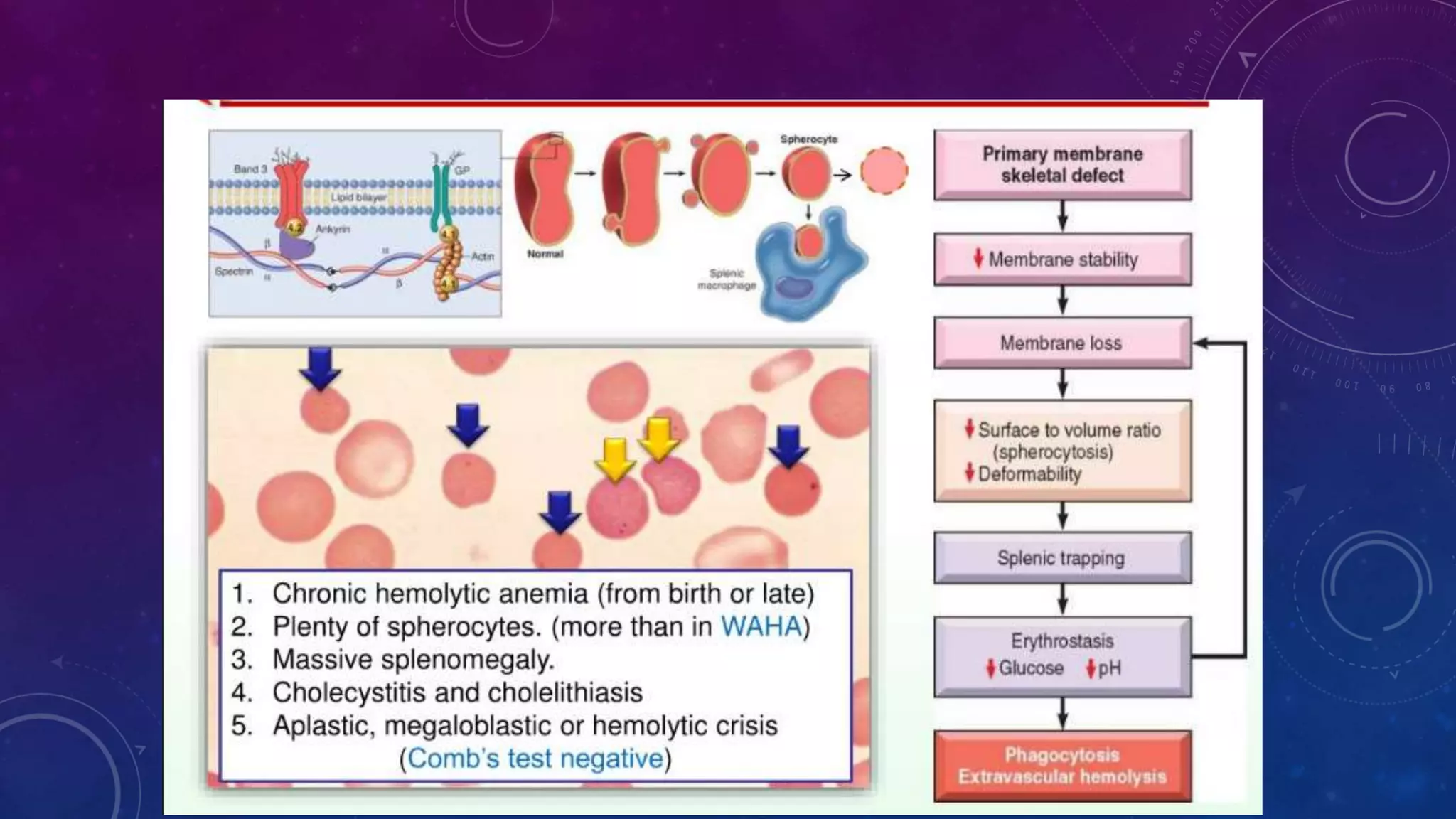 Hereditary spherocytosis.pptx