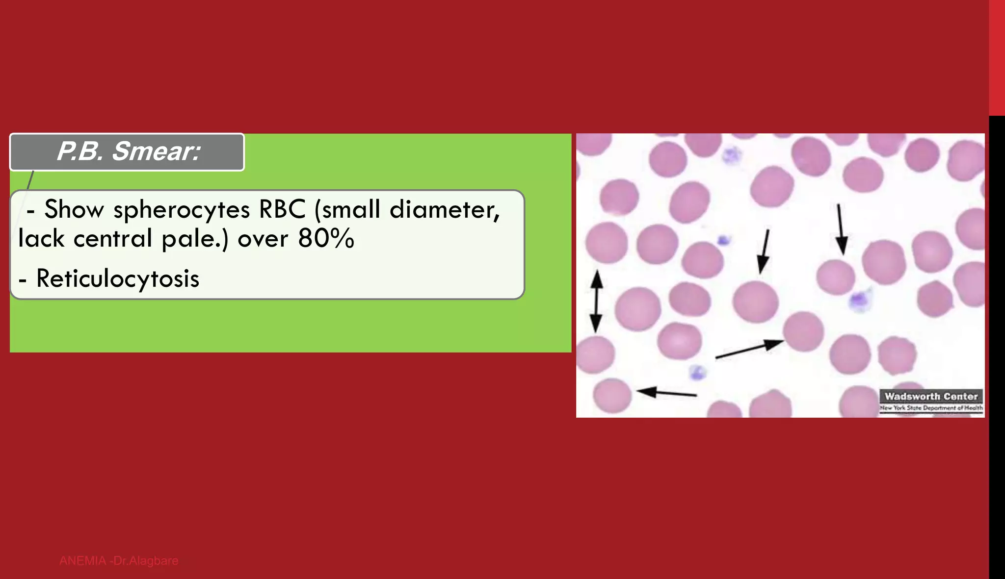 Hereditary Spherocytosis -HS | PDF