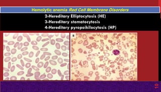 Hereditary Spherocytosis -HS | PDF