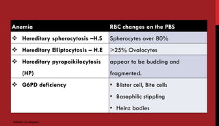 Hereditary Spherocytosis -HS | PDF