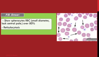 Hereditary Spherocytosis -HS | PDF
