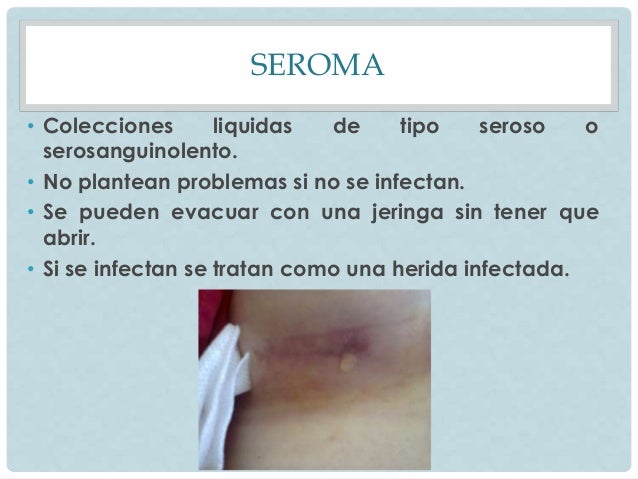 Herida quirúrgica e infectada