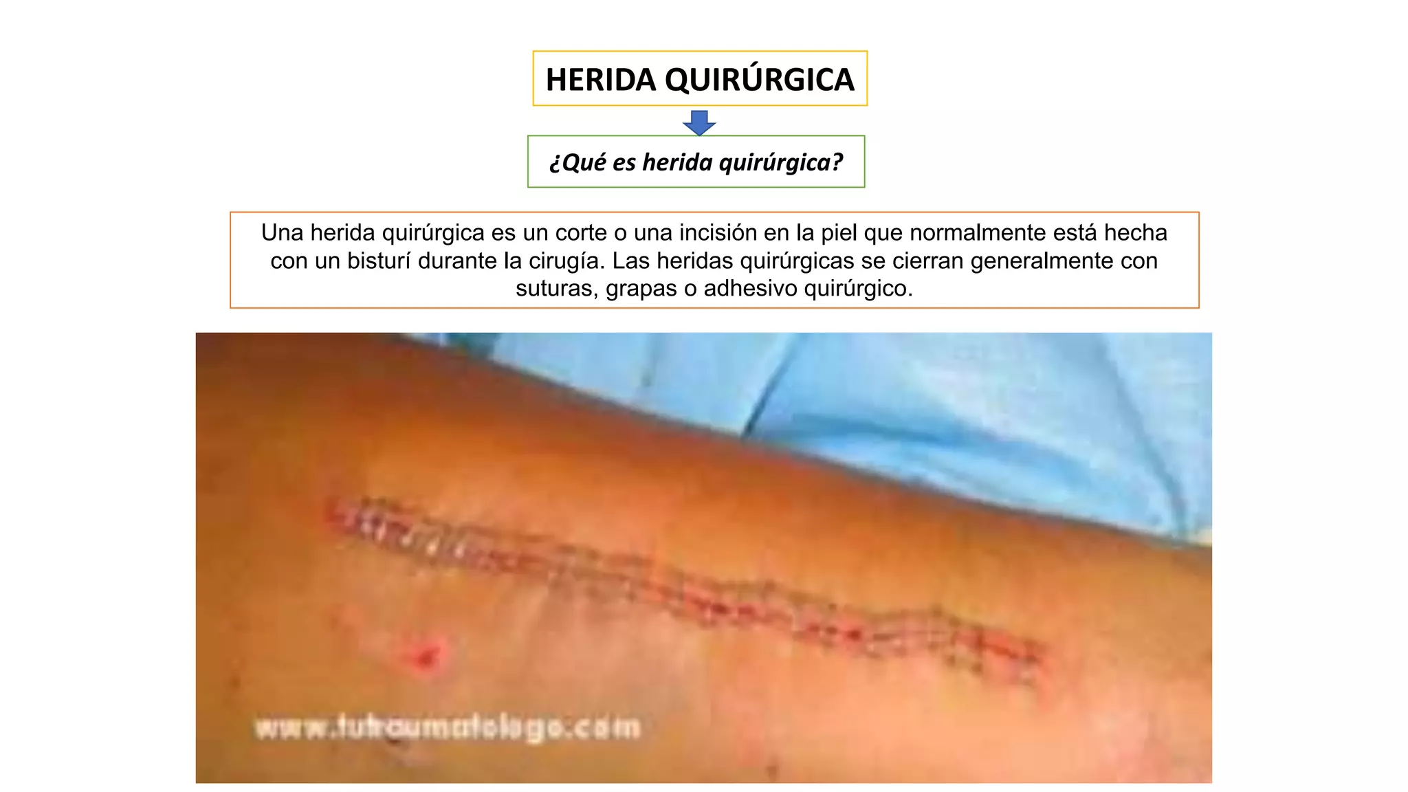 Herida quirurgica | PPTX