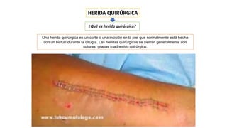 Herida quirurgica | PPTX