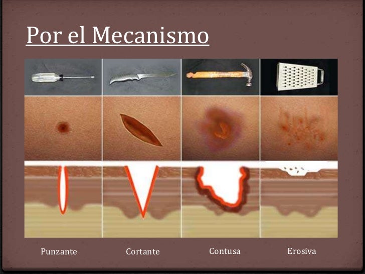 Heridas y Tipos