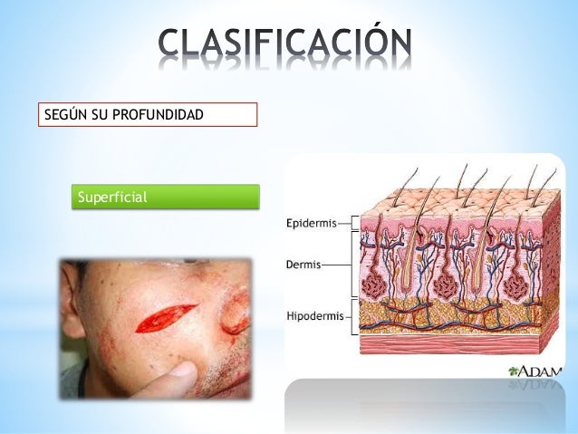 Heridas