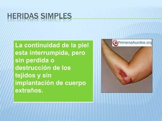 Heridas | PPTX