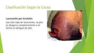 Heridas, Fisiopatología, Clasificación, Complicaciones | PPTX
