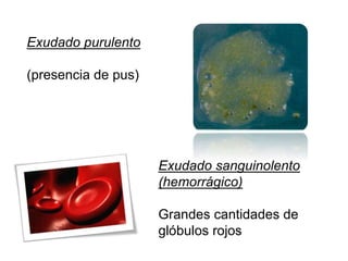 Tipos de heridas | PPTX