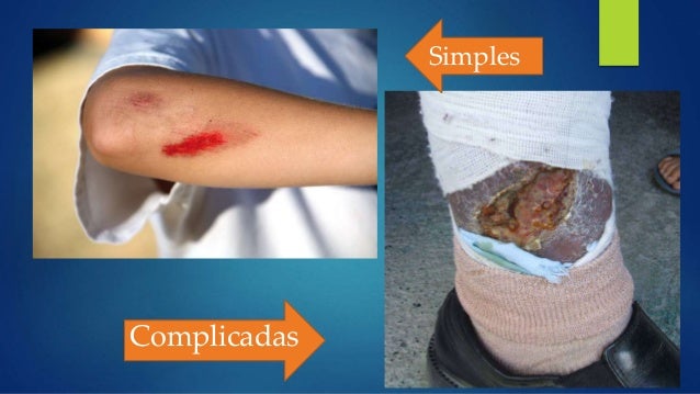 Heridas