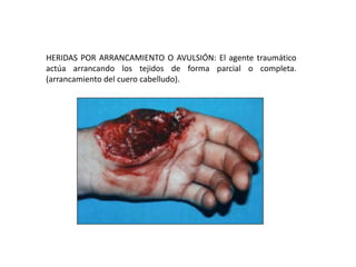 Clasificación De Las Heridas Pptx