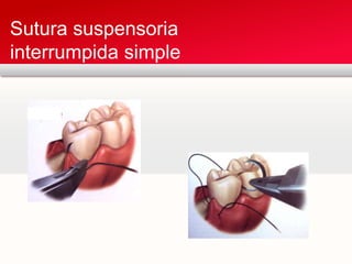 Heridas | PPTX