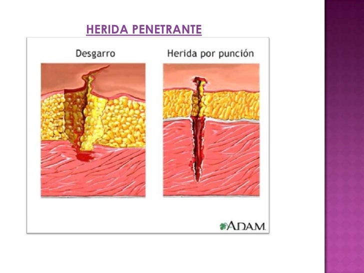 Heridas2