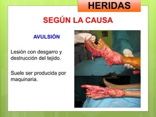 HERIDAS CLASIFICACIÓN DE HERIDAS Y SU MANEJO | PPTX
