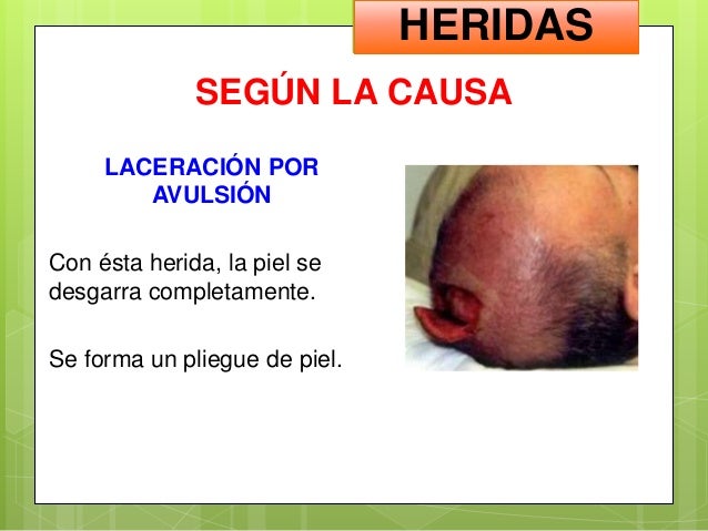 HERIDAS CLASIFICACIÓN DE HERIDAS Y SU MANEJO