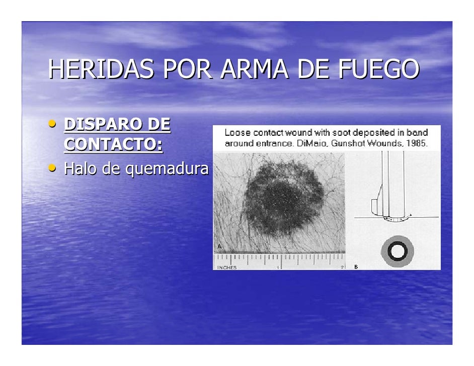 Heridas por arma de fuego