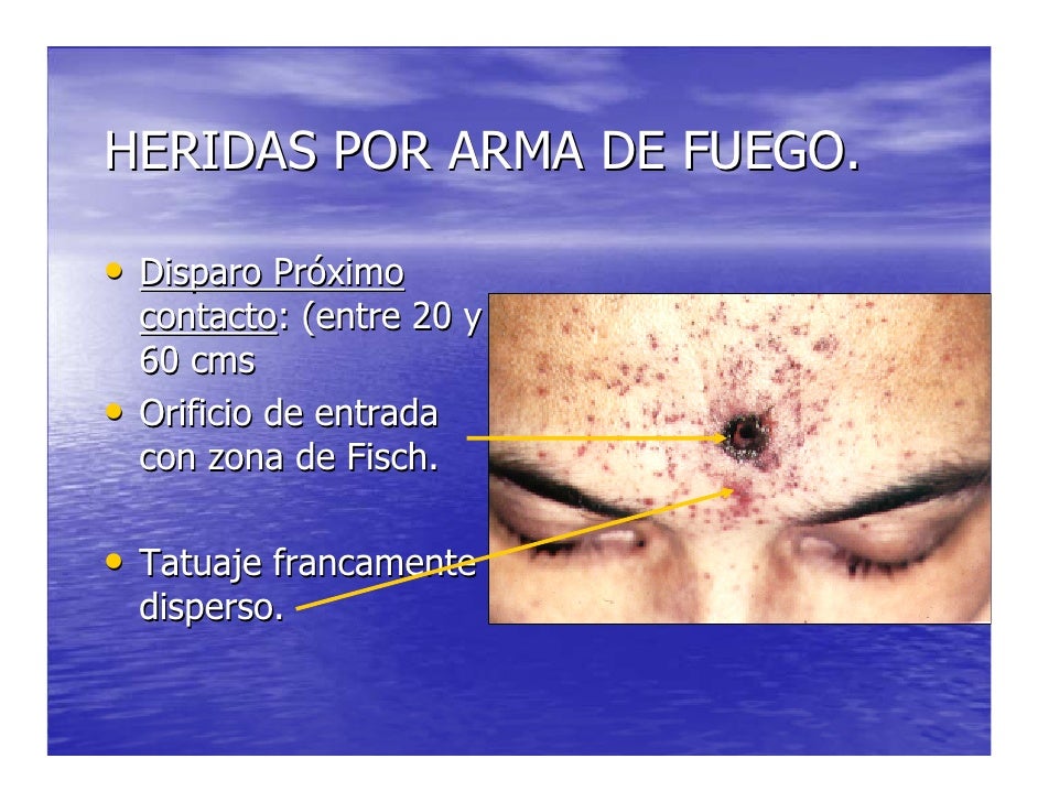 Heridas por arma de fuego