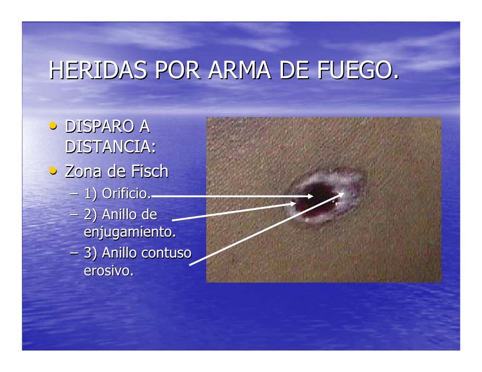 Heridas por arma de fuego