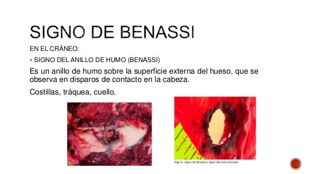 Heridas por arma de fuego Medicina Legal