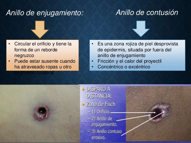 Heridas por arma de fuego