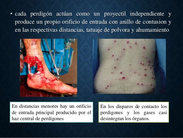 Heridas por arma de fuego