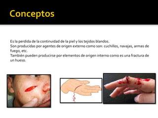 Heridas De Entrada Y Salida Por Arma De Fuego