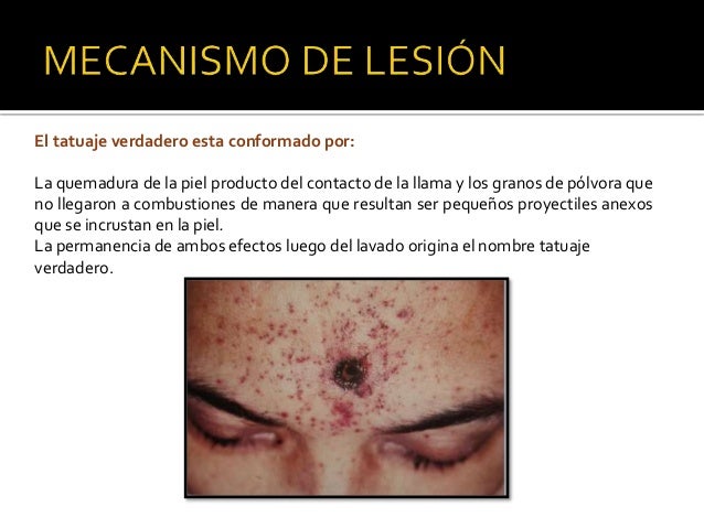 Heridas por arma de fuego traumatologia