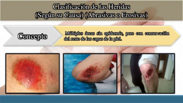 Heridas y clasificacion