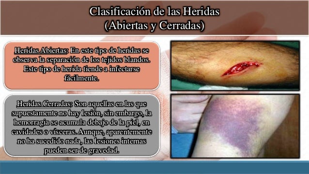 Heridas y clasificacion