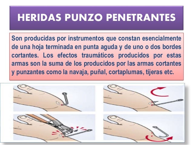 Heridas punzo penetrantes.edgar