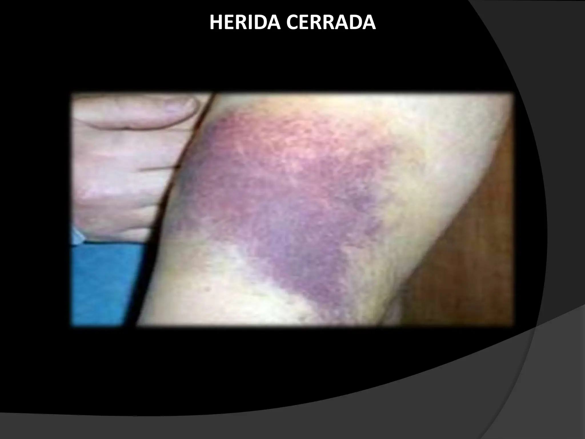 heridas y curaciones, clasificacion , ejemplos y fotos | PPT