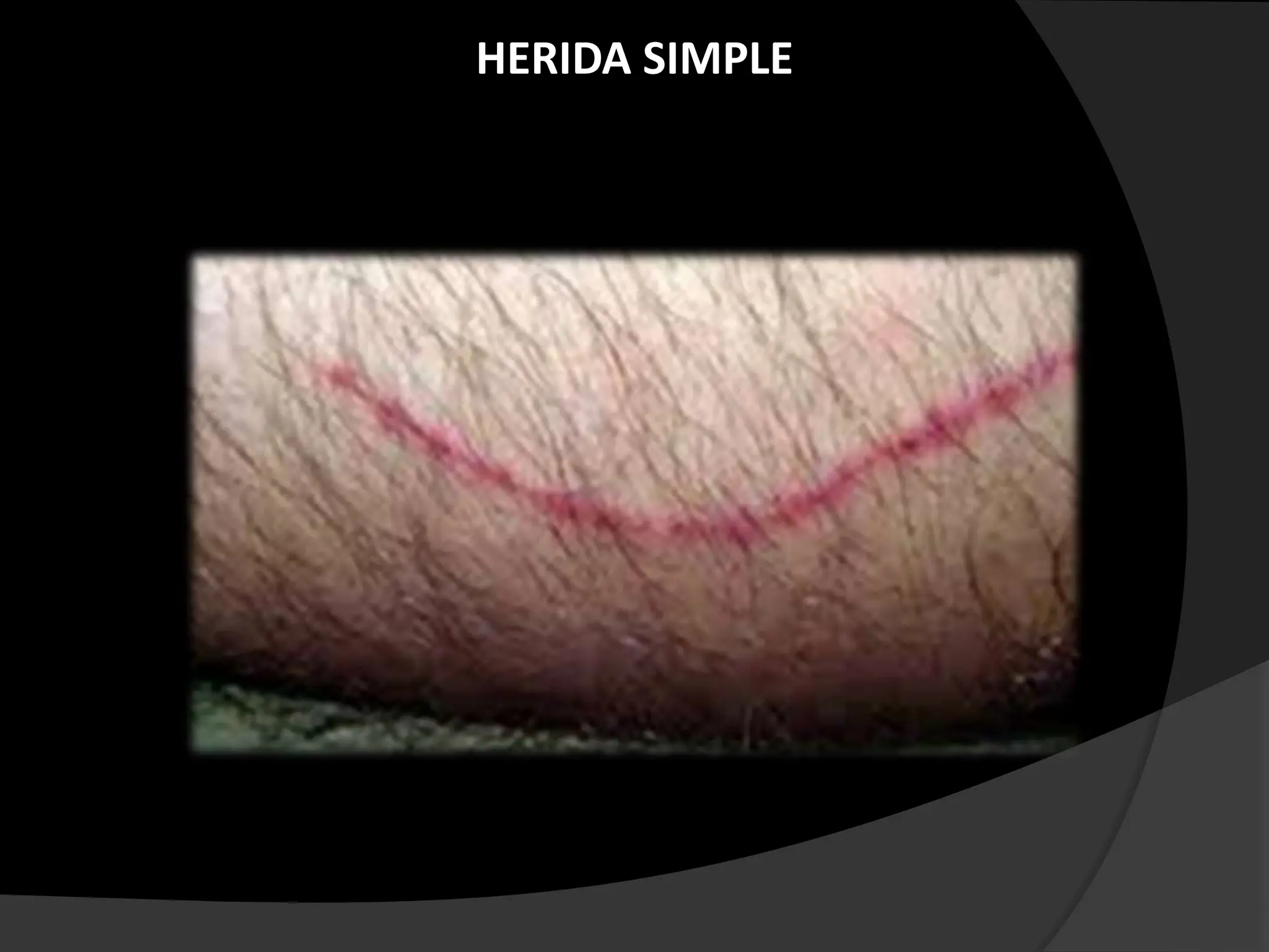 heridas y curaciones, clasificacion , ejemplos y fotos | PPT