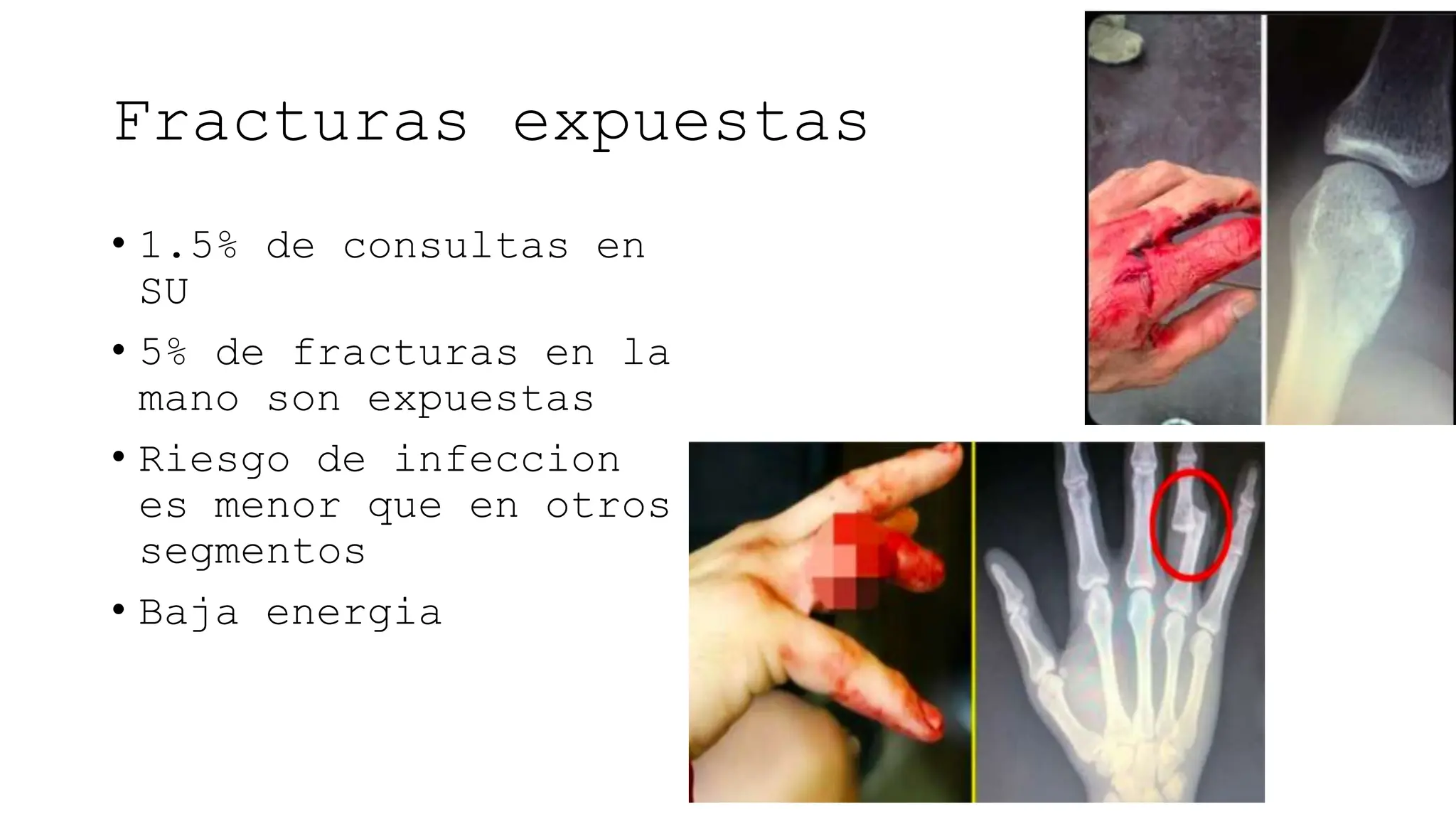 Heridas y fracturas expuestas de la mano 2.pptx