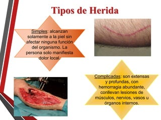 Heridas y Quemaduras | PPTX
